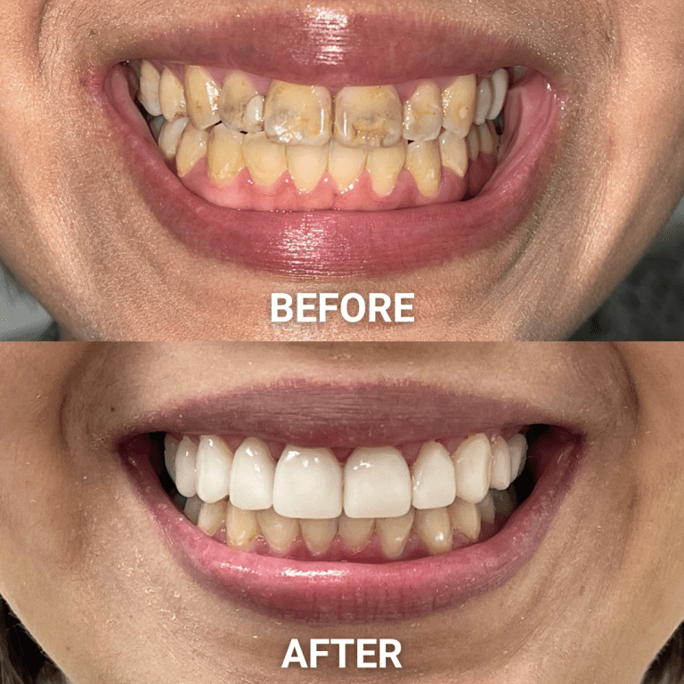 Veneers Treatment Adelaide | Adelaide Cosmetic Dentistry